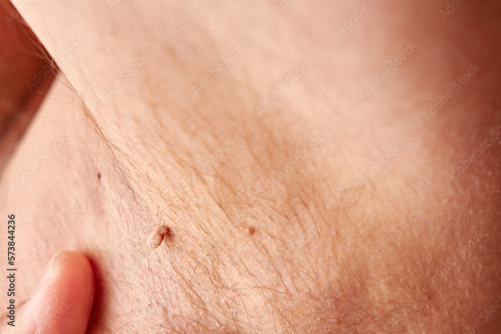 Large papilloma under the armpit of a man. Skin disease. Skin care ...