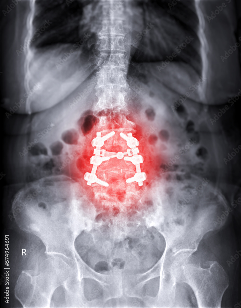 X-ray image of Lumbar spine showing pedicle screw fixation and ...