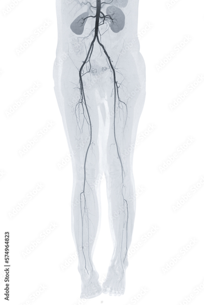 CTA femoral artery run off showing femoral artery Presenting with Acute ...