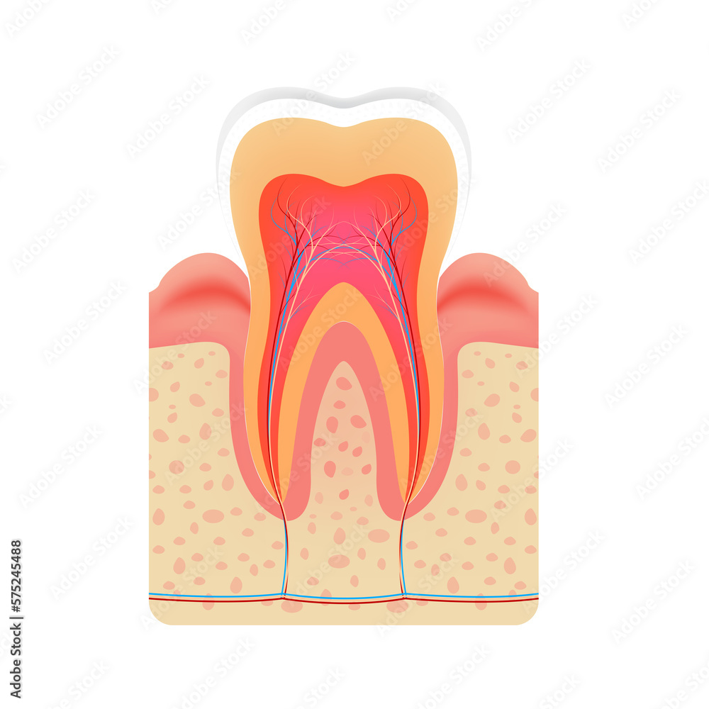 Tooth caries stages, development of teeth decay with enamel and dentin ...