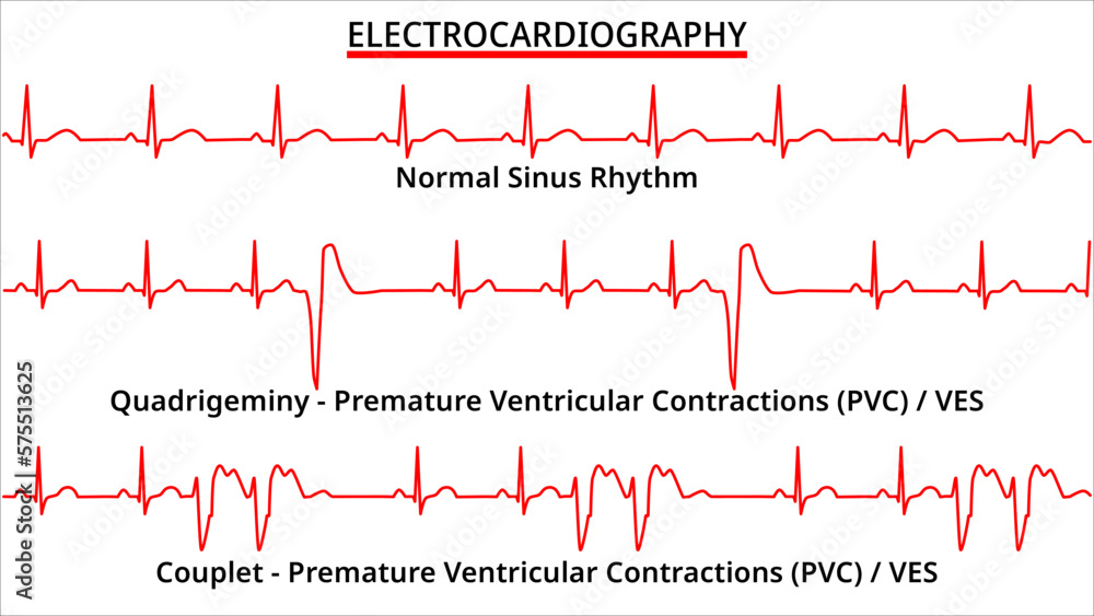 Premature Ventricular Contraction Ecg