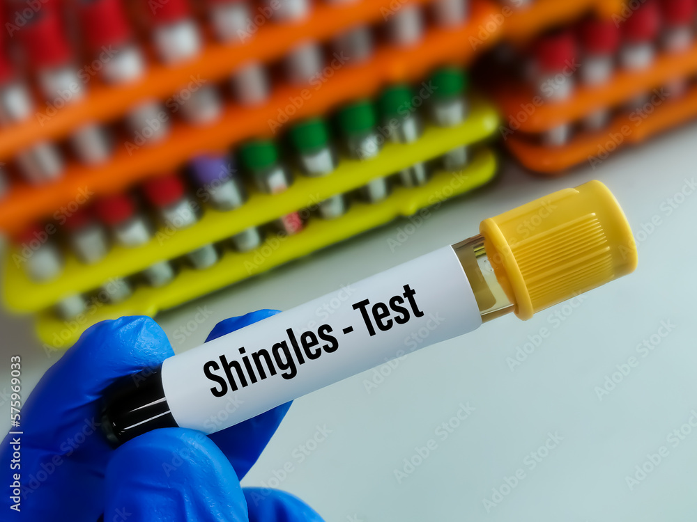 Blood sample for shingles test, a viral disease caused by is caused by ...