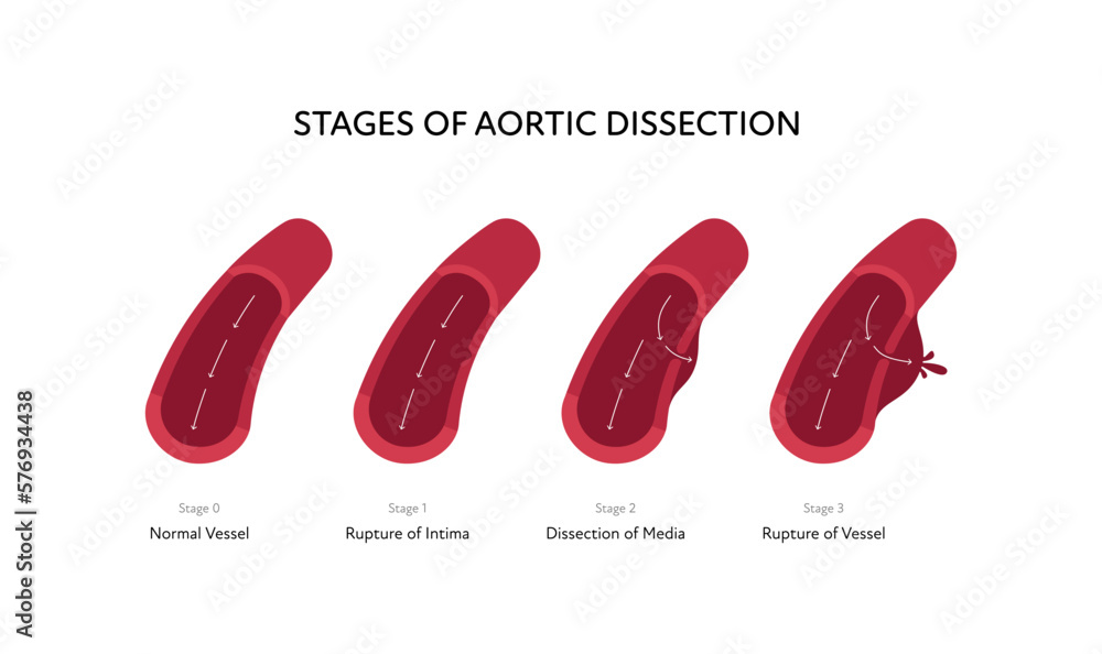 Blood vessel anatomy disease infographic chart. Vector color flat ...