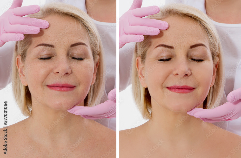 Closeup before after Beauty middle age woman face portrait. Before ...