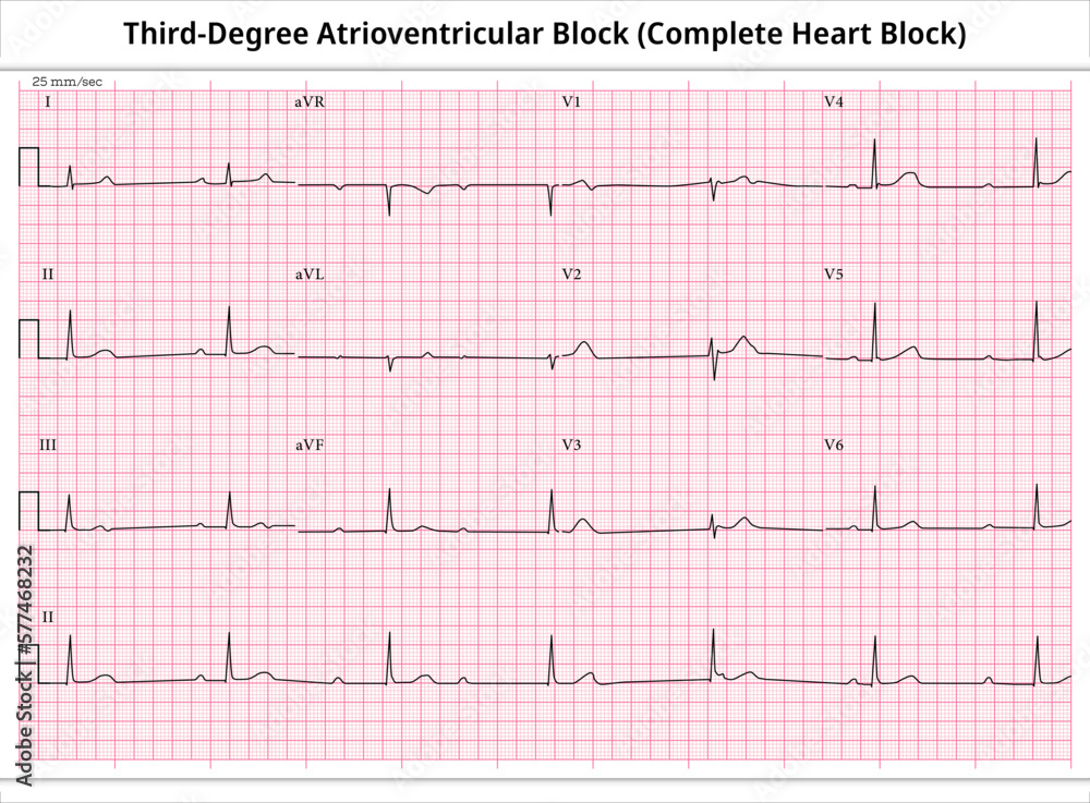 Third Degree Atrioventricular Block - ECG Paper 12 Lead - Electrocardiogram - Vector Medical ...