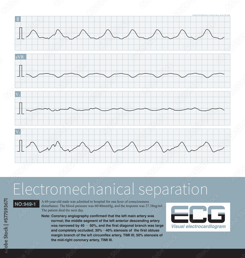 Electromechanical separation is a kind of terminal ECG. The patient's ...
