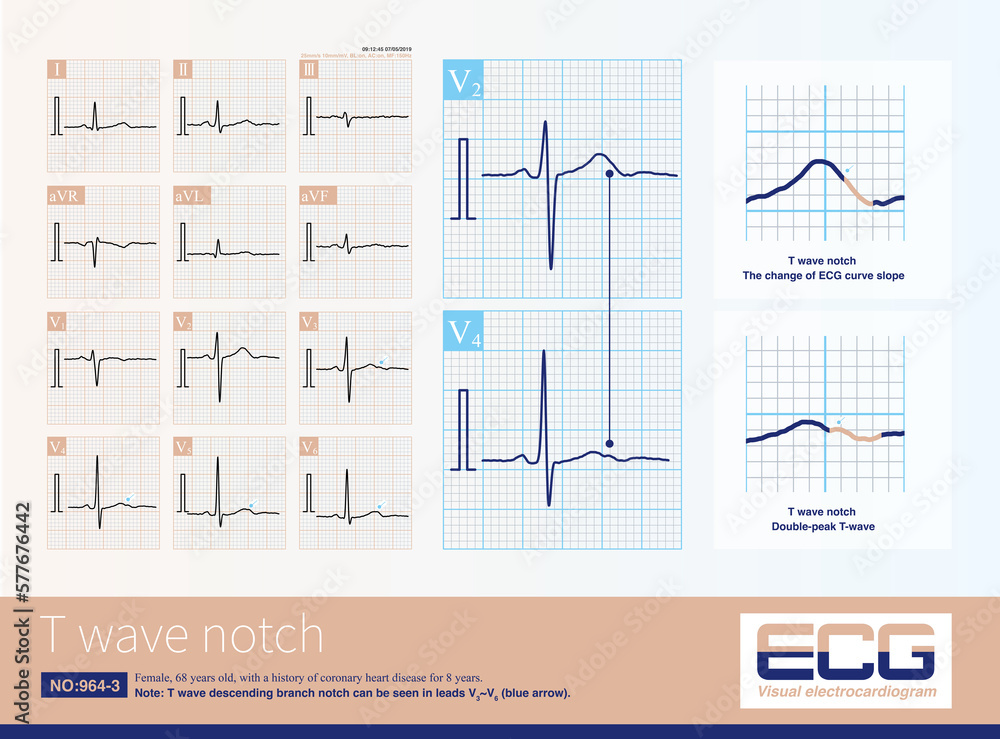 When the repolarization desynchronization difference between the left ...