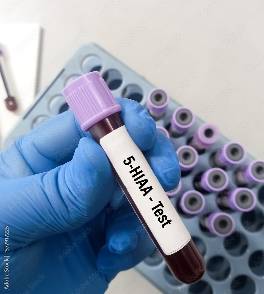 Blood sample for 5-HIAA (5-Hydroxyindoleacetic acid) test, used to help ...