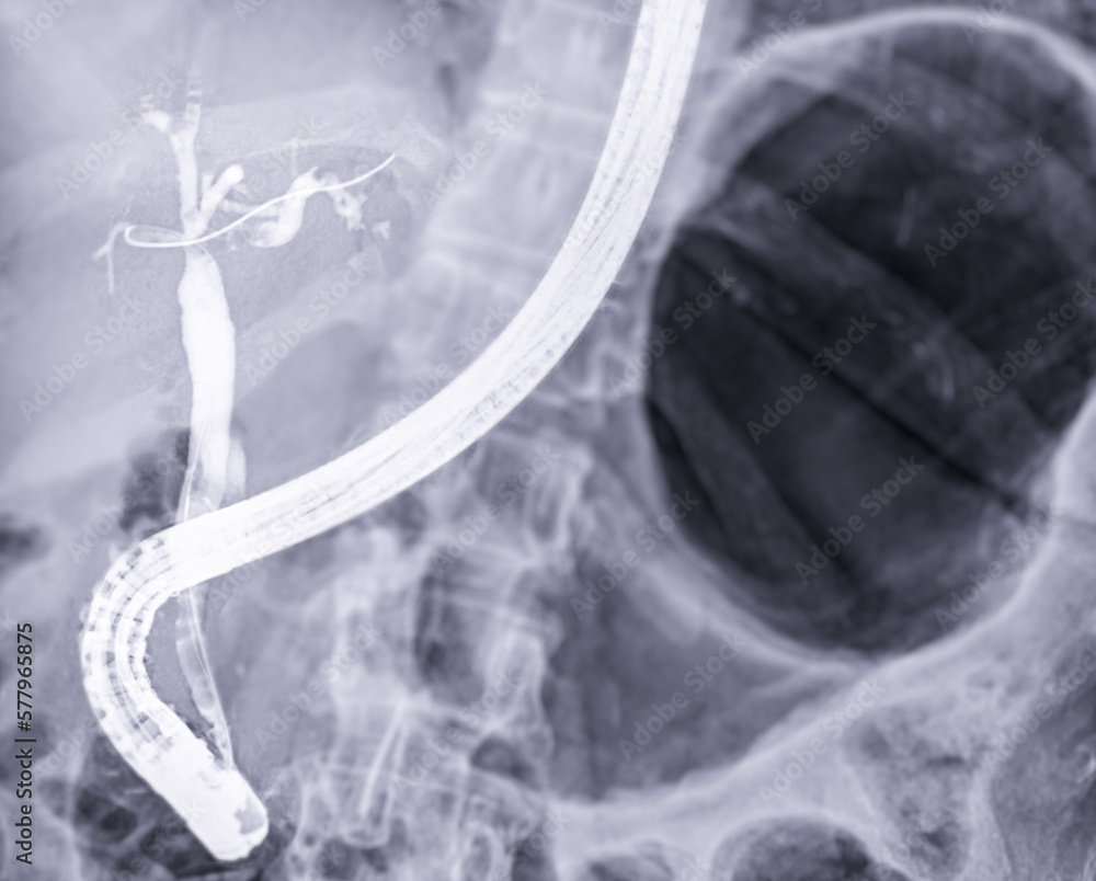 X-ray image of endoscopic after Doctor doing ERCP and laparoscopic ...