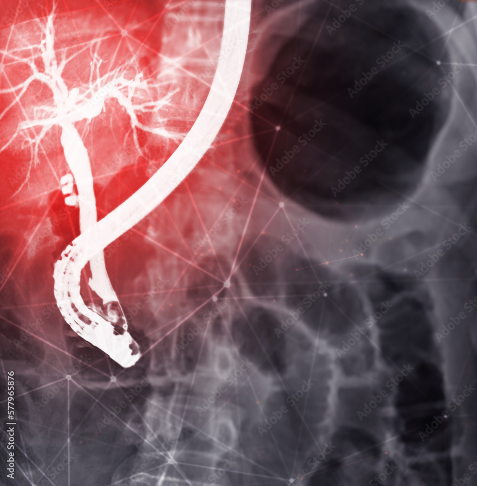 X-ray image of endoscopic after Doctor doing ERCP and laparoscopic ...