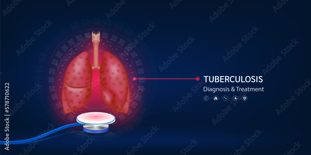Tuberculosis Pneumonitis disease. Human lungs model float away from ...