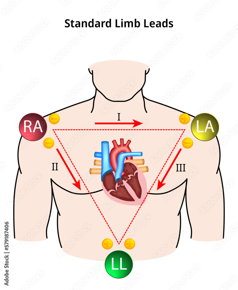 Standard Limb Leads ECG - Einthoven Triangle - Electrocardiogram ... Standard Limb Leads ECG - Einthoven Triangle - Electrocardiogram ...