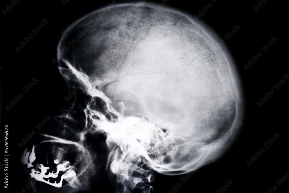 X-ray radiograph of the skull human. Stock Photo | Adobe Stock