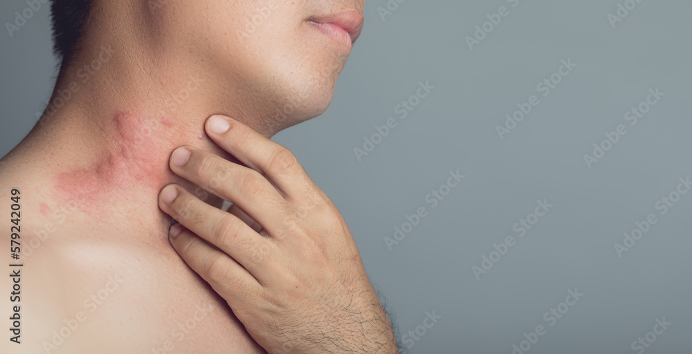 Man having red papules, itchy rash and scratching his neck. Skin ...