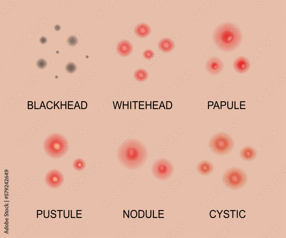 Stock-Vektorgrafik „Different types of acne. Acne skin types ...