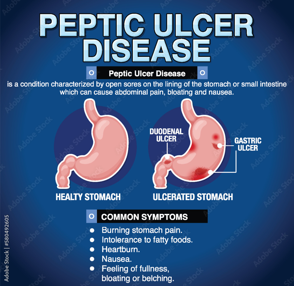 Peptic Ulcer Disease Explained Infographic Stock Vector | Adobe Stock
