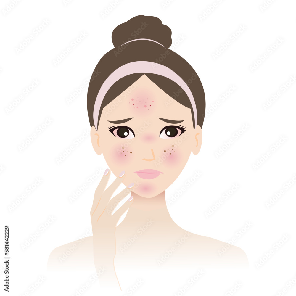 The skin allergy on woman face vector isolated on white background. The ...