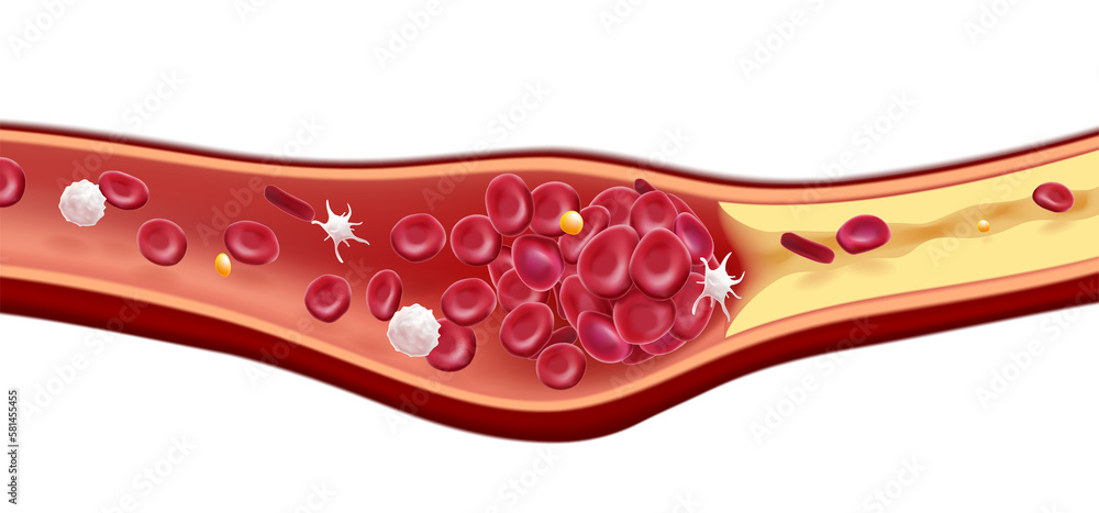 3D illustration of red blood cells and cholesterol clots cause death ...