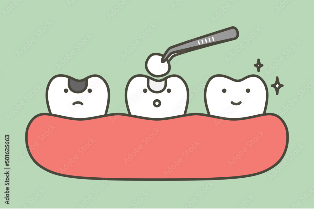 step of tooth amalgam filling by dental tools to protection decay tooth ...