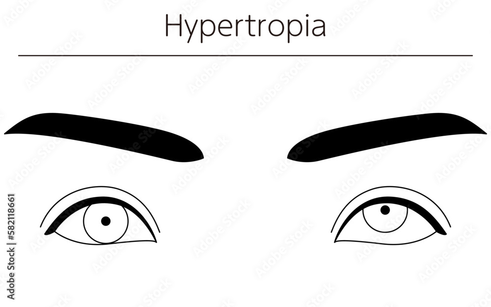 Medical illustrations, diagrammatic line drawings of eye diseases ...
