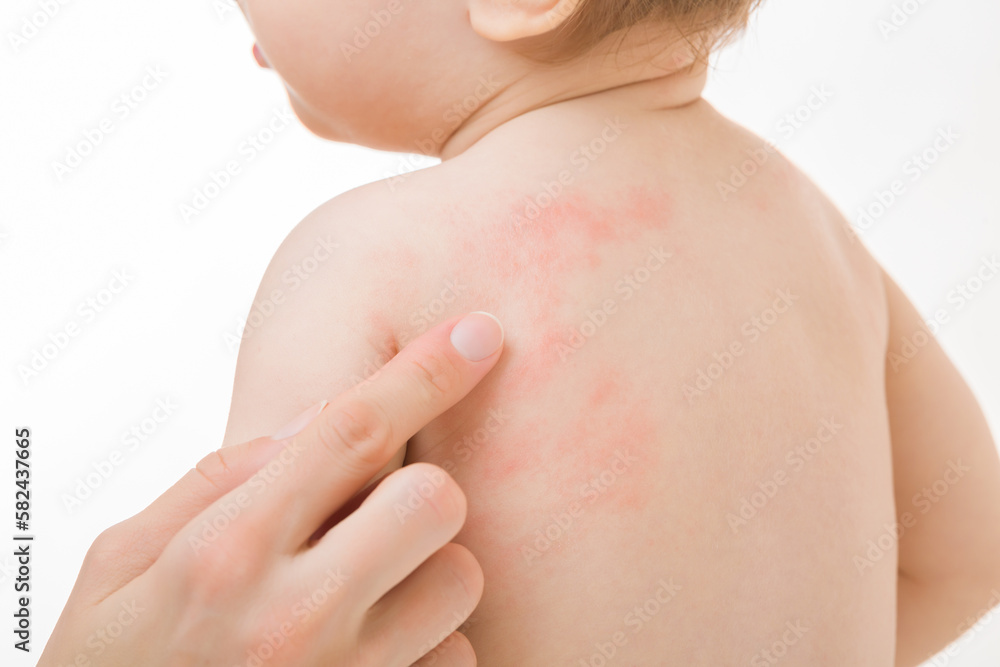 Young adult mother finger pointing to red rash on infant back. Baby boy ...