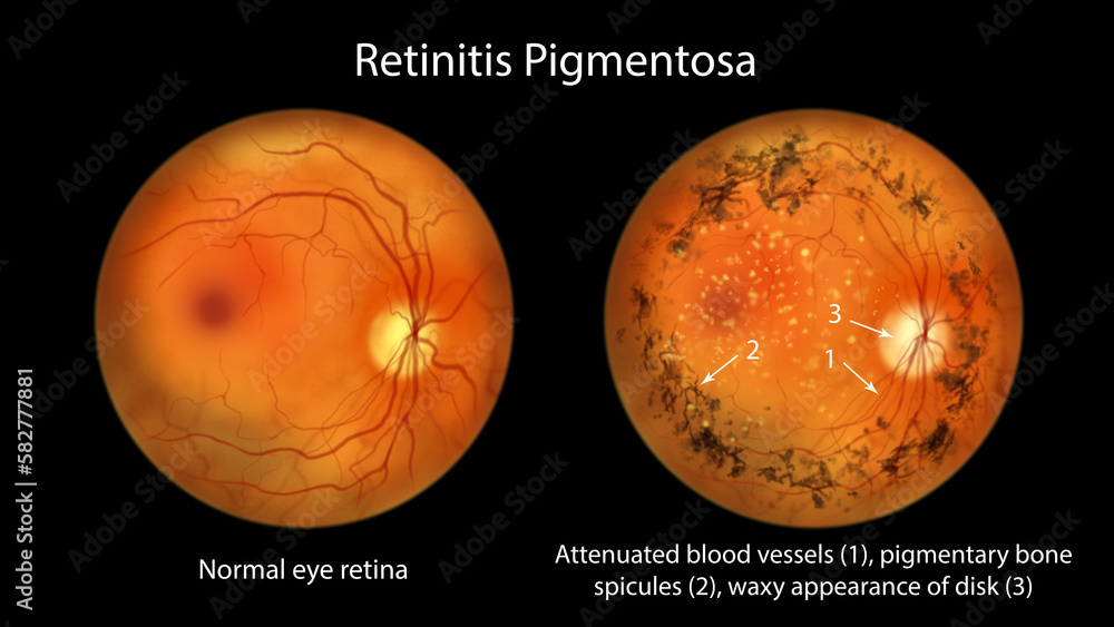 Retinitis pigmentosa, a genetic eye disease leading to vision loss. An ...