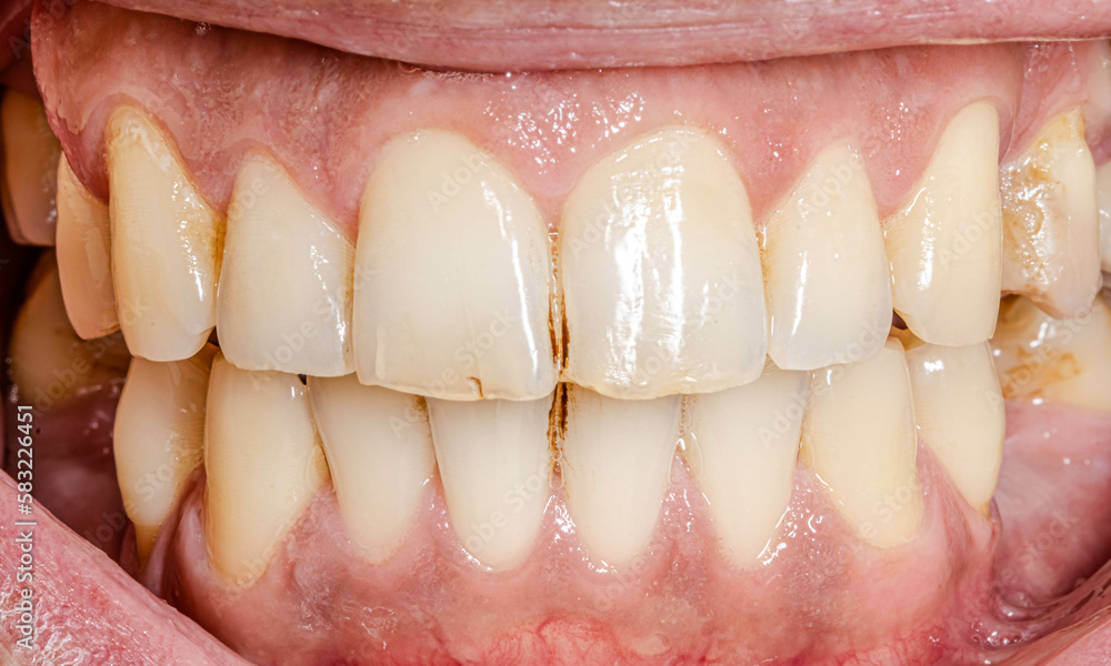 Front view of dental arches in occlusion, lips and cheeks retracted ...