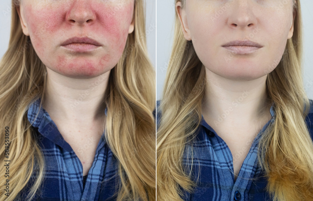 Rosacea face. The girl suffers from redness on her cheeks. Couperosis ...