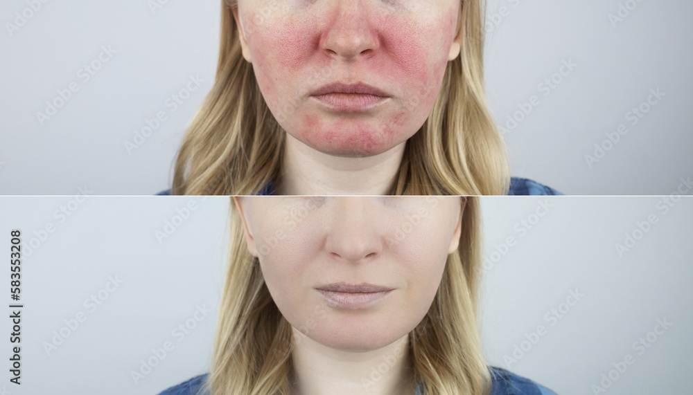 Rosacea face. The girl suffers from redness on her cheeks. Couperosis ...