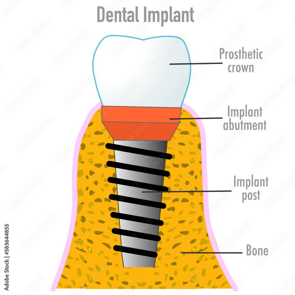 Stock-Vektorgrafik „Dental implant structure, teeth anatomy. Tooth ...