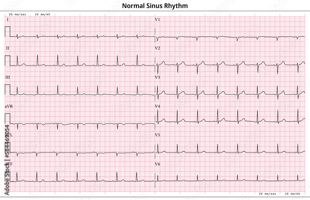ECG Normal Sinus Rhythm - 12 Lead ECG Common Case - 6 Sec/lead - Vector ...