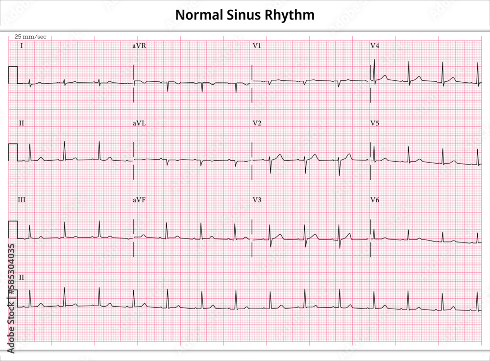 ECG Normal Sinus Rhythm - 12 Lead ECG Common Case - 3 Sec/lead - Vector ...