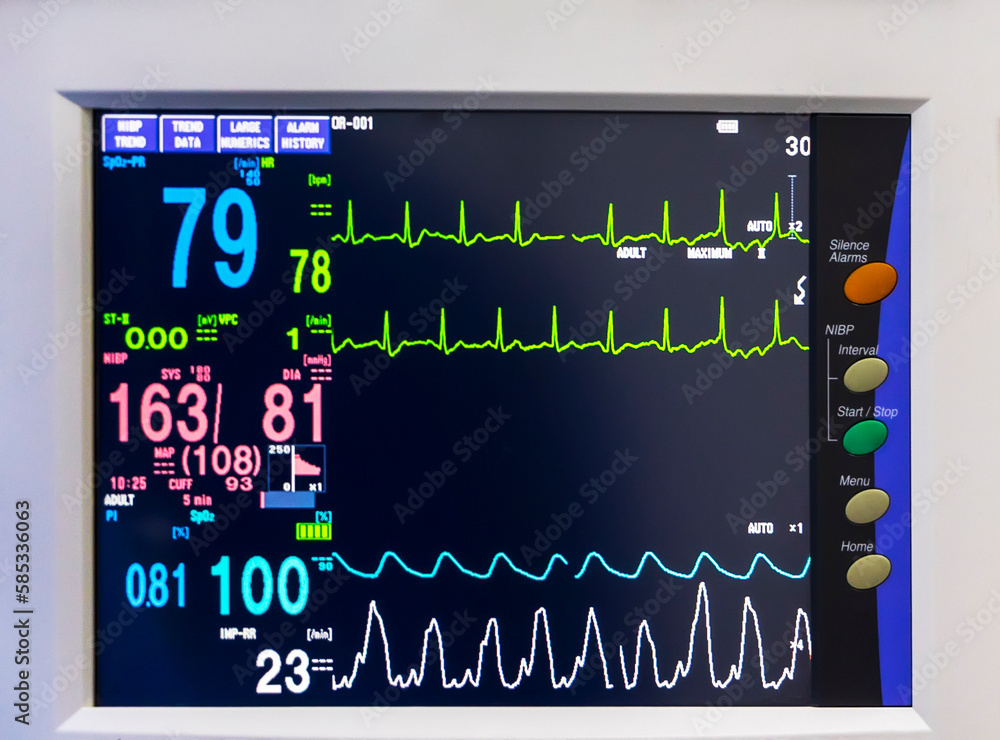Medical vital sign monitor screen in operating room or hospital.Heart ...