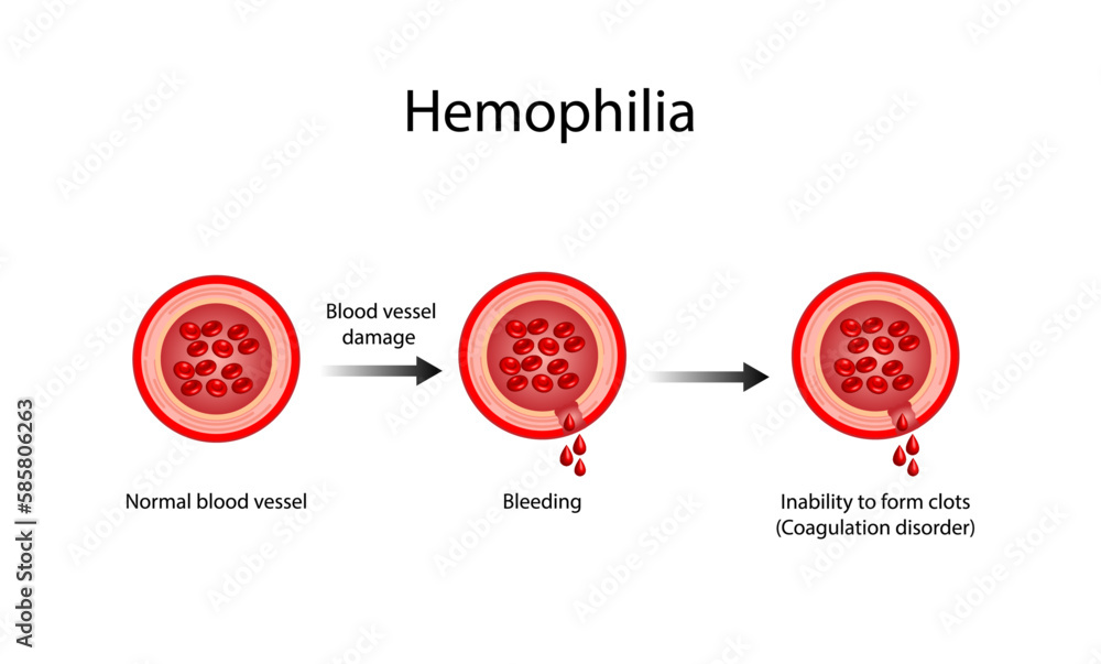 Hemophilia, a bleeding disorder that slows the blood clotting. Haemophilia (Coagulation disorder ...