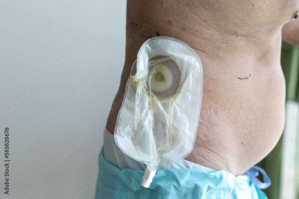 Colostomy bag , Wound and Ostomy ,Kidney Stone, an old patient have ...