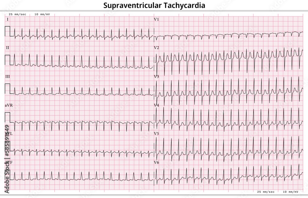 ECG Supraventricular Tachycardia (SVT) - 12 Lead ECG Common Case - 6 ...