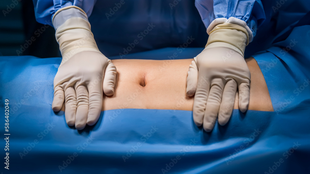Abdomen prepare for abdominal surgery with sterile drape.Surgeon or ...