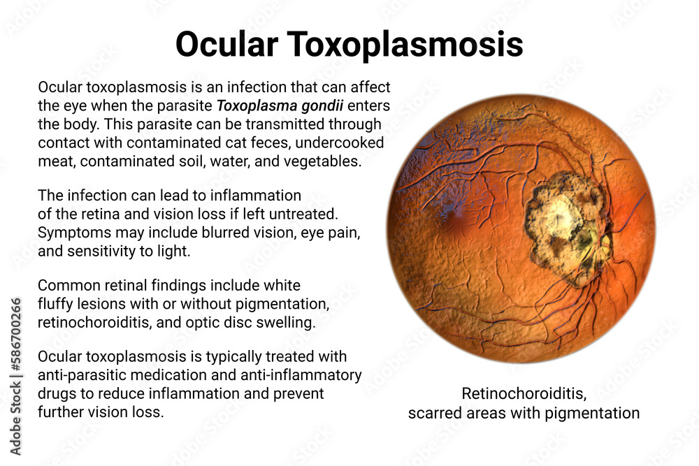 Ocular toxoplasmosis, retinal scar caused by a Toxoplasma gondii ...
