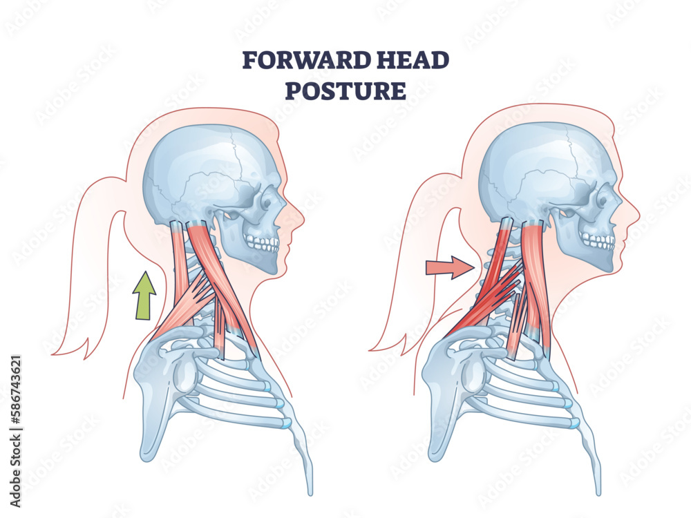 Forward head posture compared with healthy neck position outline ...
