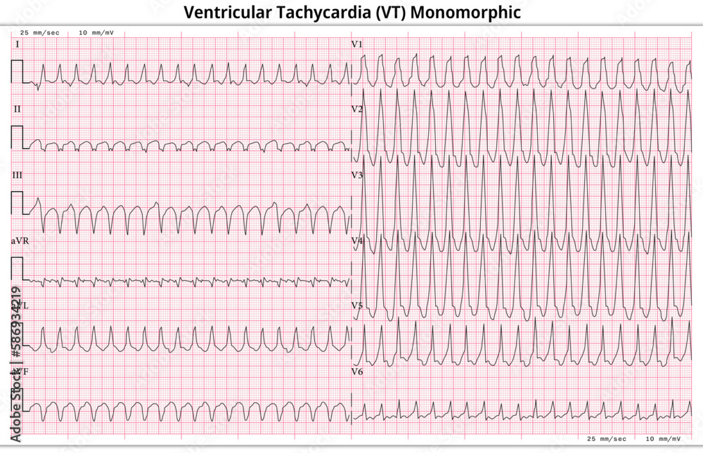 Vector de Stock ECG Ventricular Tachycardia Monomorphic - 12 Lead ECG ...