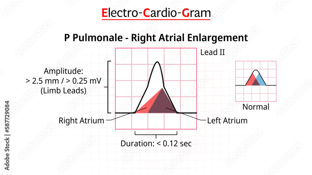 P Wave - P Pulmonale - ECG Right Atrial Enlargement/Hypertrophy ...