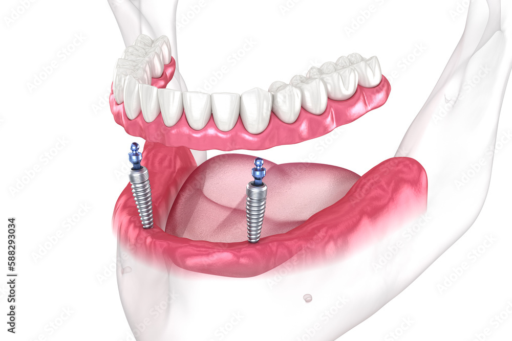 Mandibular removable prosthesis All on 2 system supported by implants ...