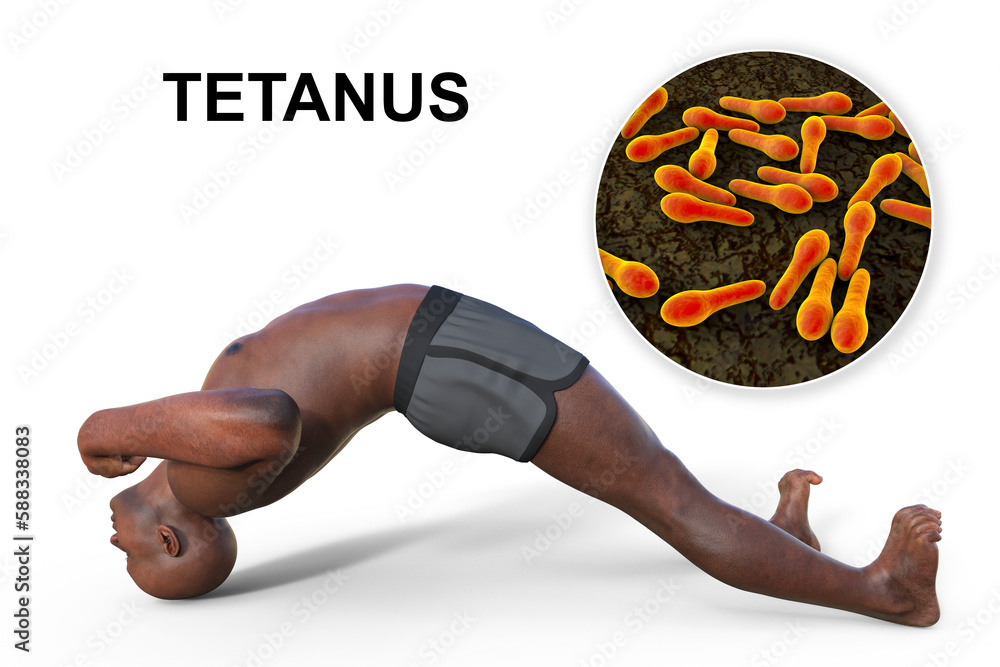 A 3D medical illustration of a black-skinned man suffering from tetanus ...