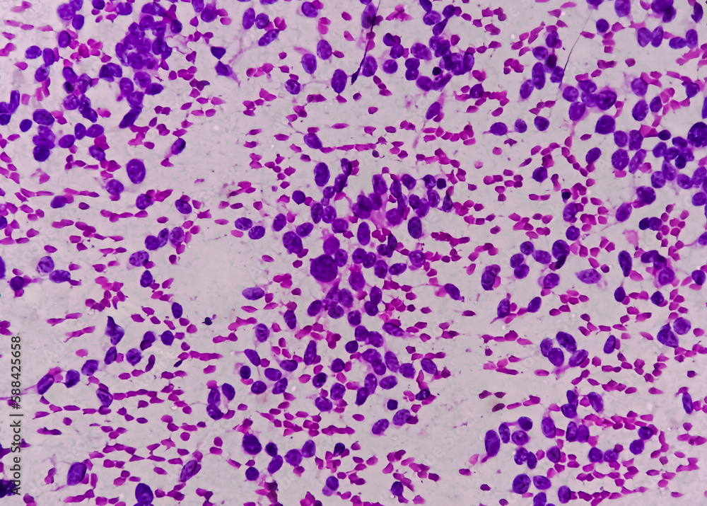 USG guided FNA cytology of liver SOL showing Non Hodgkin lymphoma ...