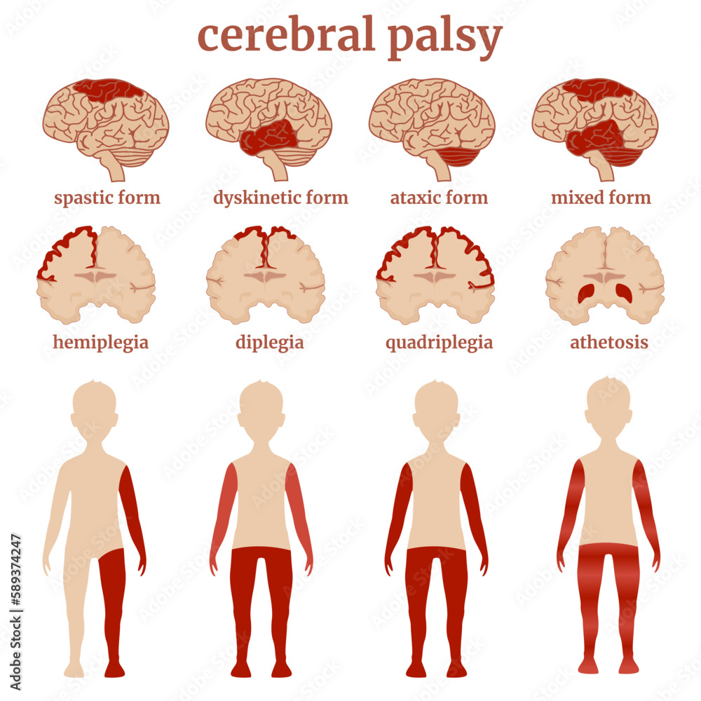 A diagram indicating the types of cerebral palsy using the example of ...