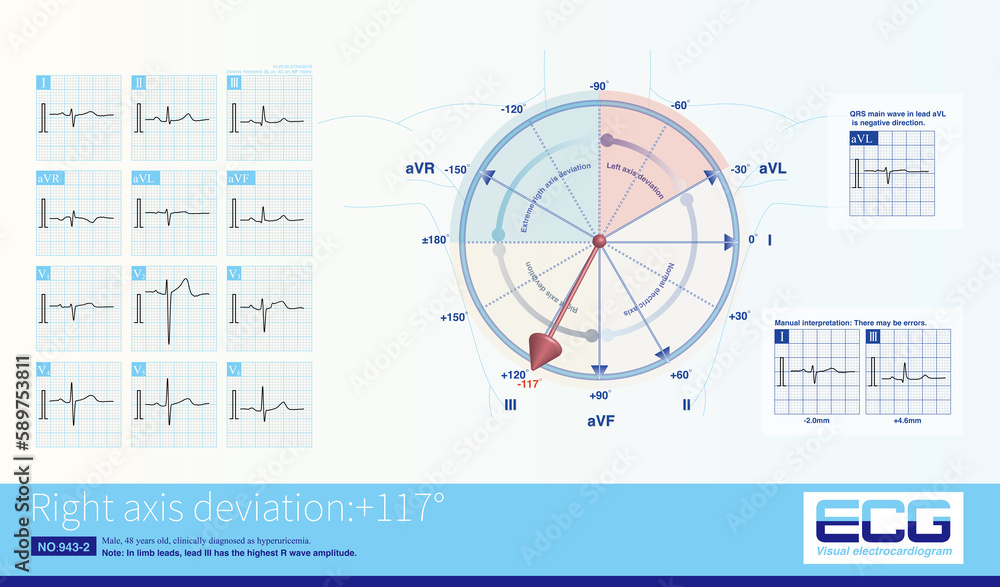 Stock-Illustration „The right axis deviation can be seen in patients ...