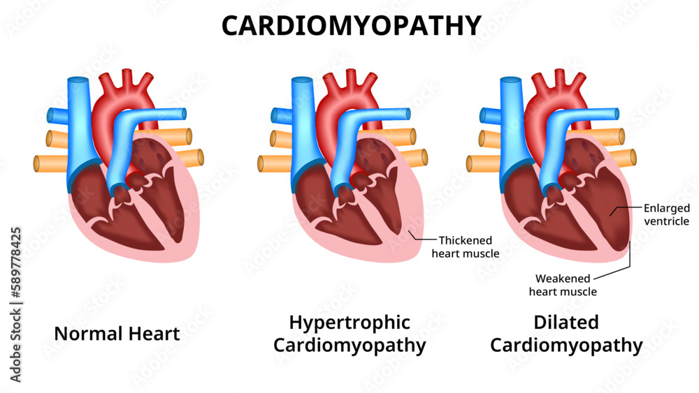 Types of heart diseases: hypertrophic cardiomyopathy and dilated ...