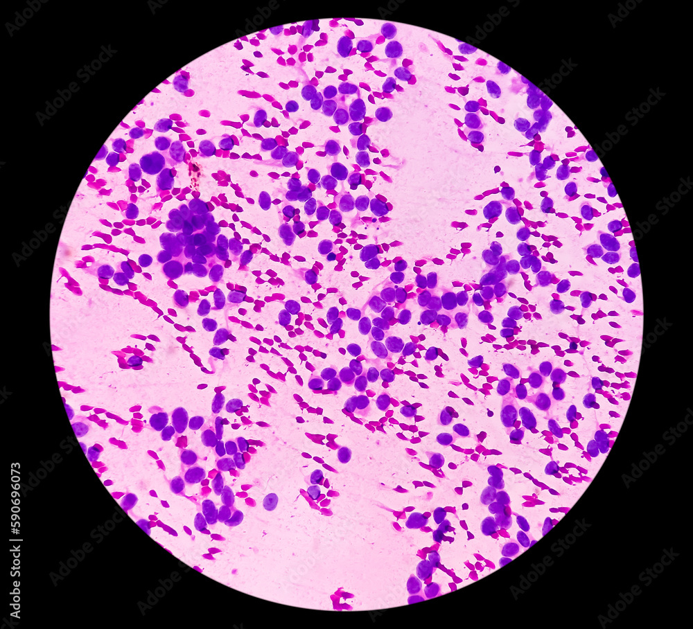 USG guided FNA cytology from liver SOL. Non-Hodgkin lymphoma. Smear ...