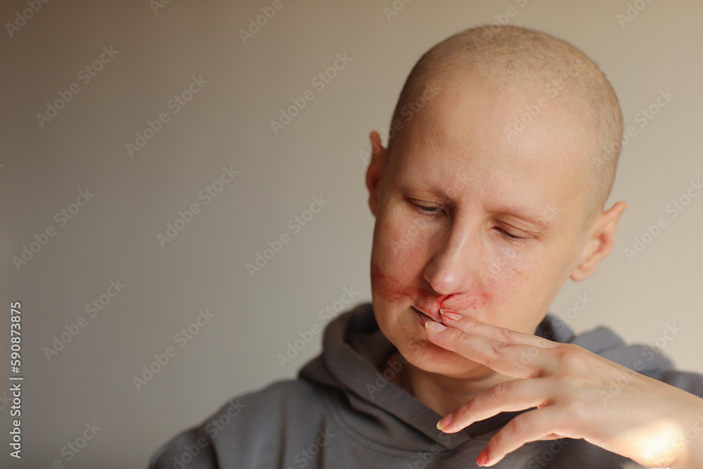 Stock-Foto „Hairless cancer sick female patient is bleeding from her ...
