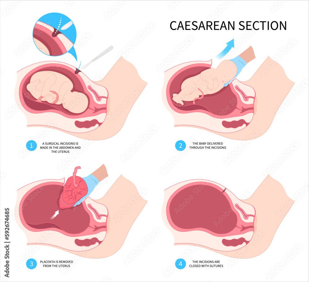 Medical Infant Childbirth Delivery Caesarean C section newborn Baby birth prolapse umbilical ...